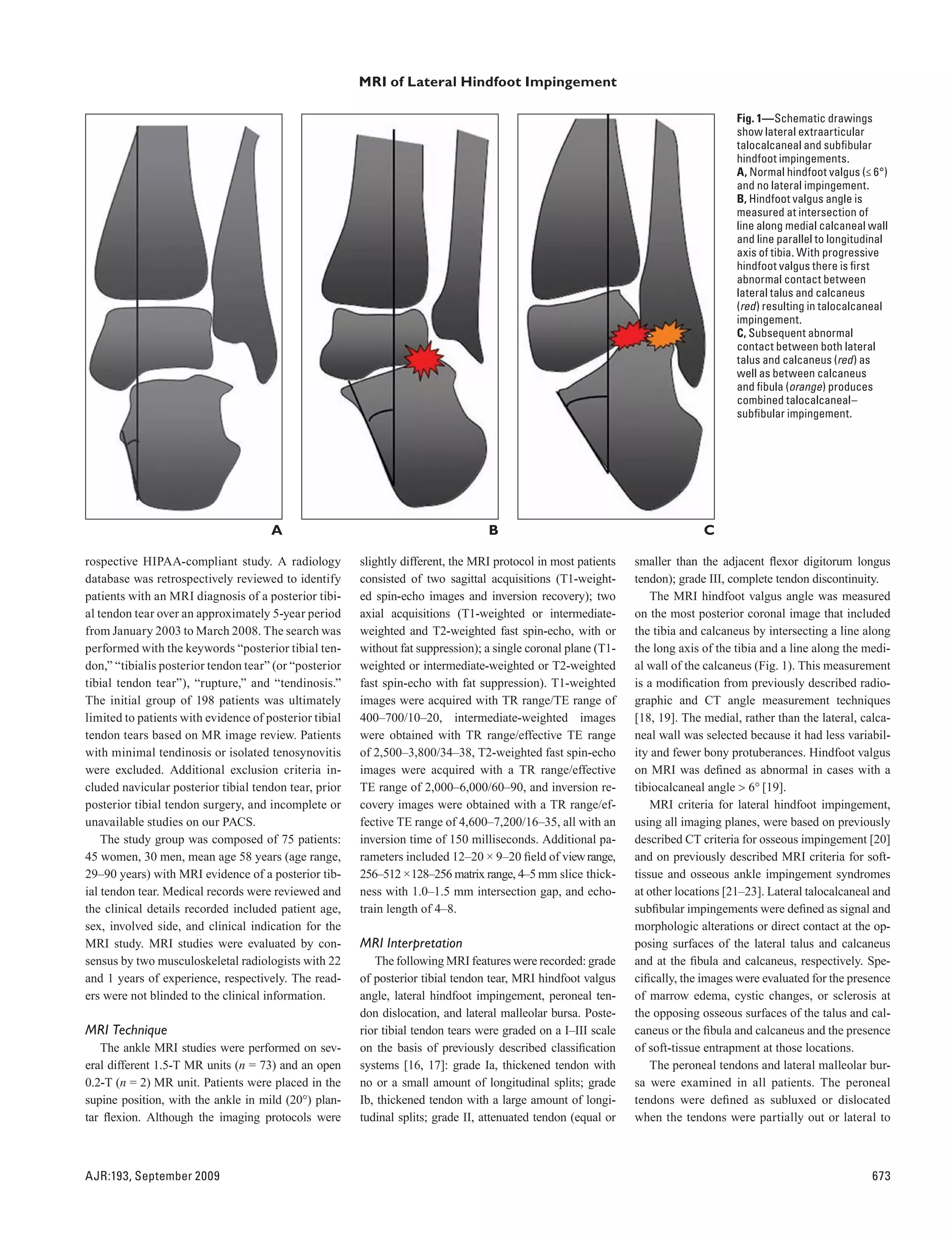 Extraarticular later hindfoot impingement with ptt tear mri correlation ...