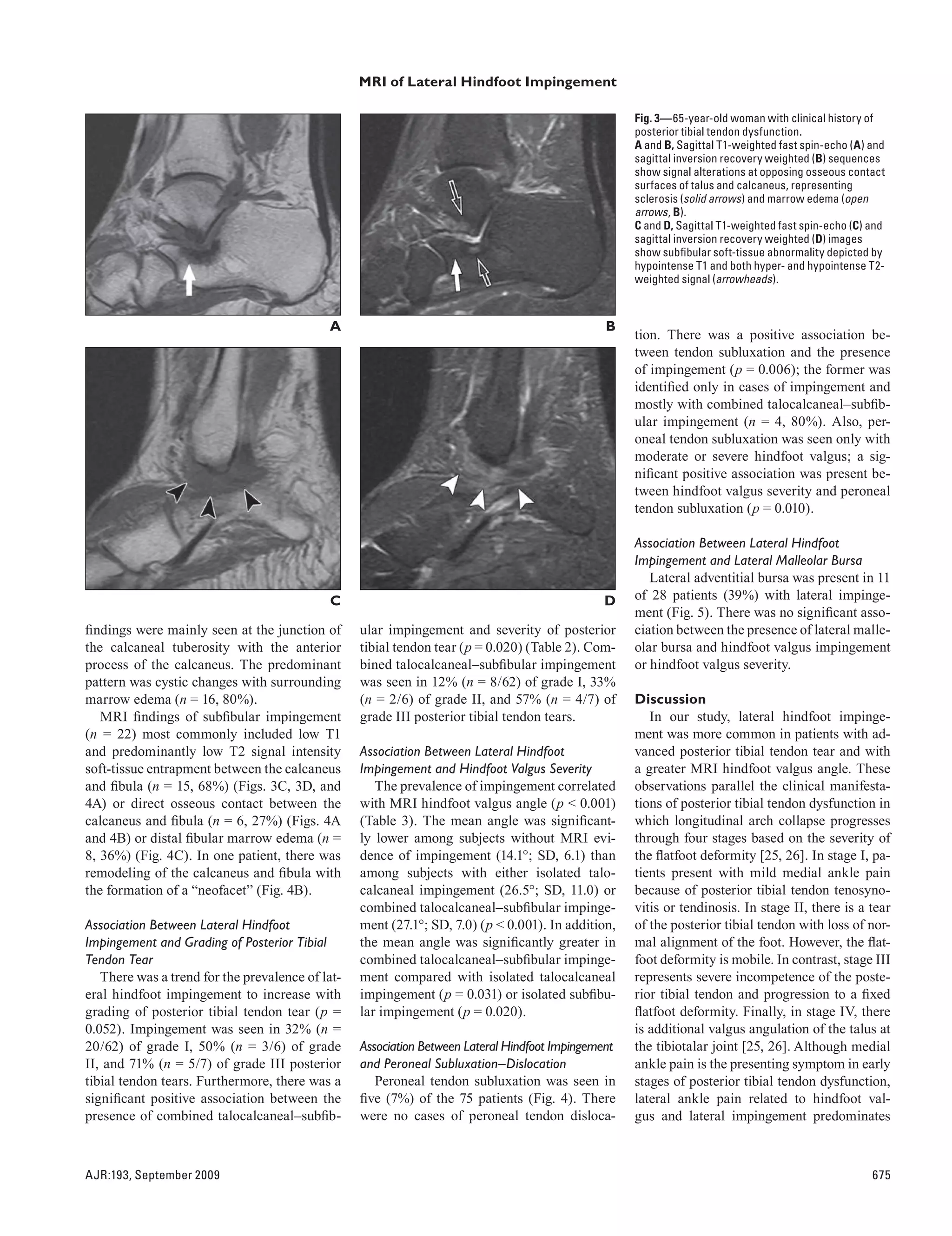 Extraarticular later hindfoot impingement with ptt tear mri correlation ...