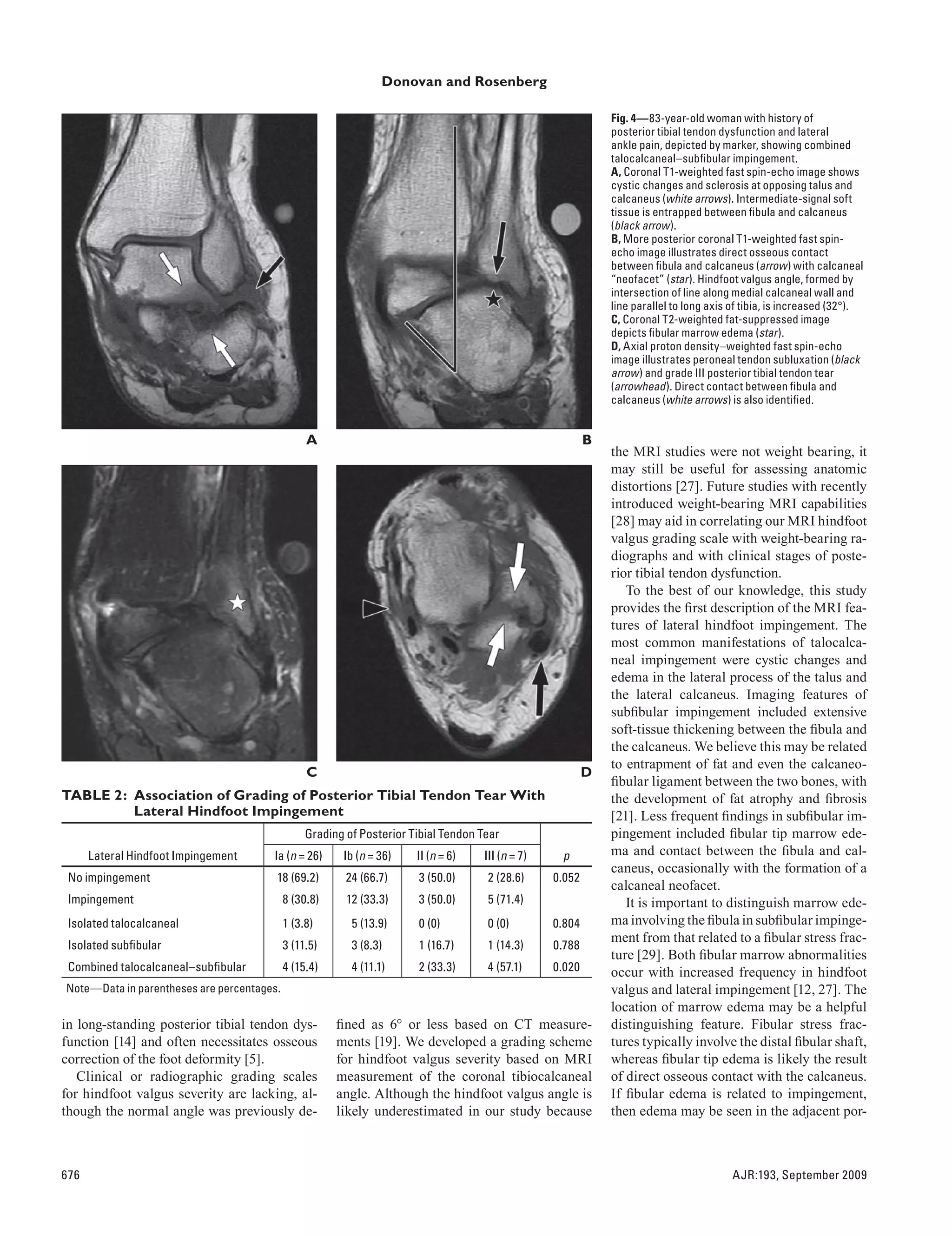 Extraarticular later hindfoot impingement with ptt tear mri correlation ...