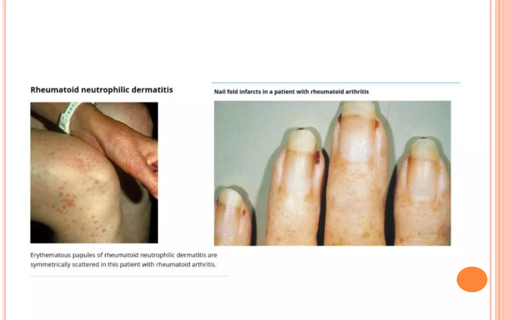 extra articular manifestation of rheumatoid arthritis.pptx