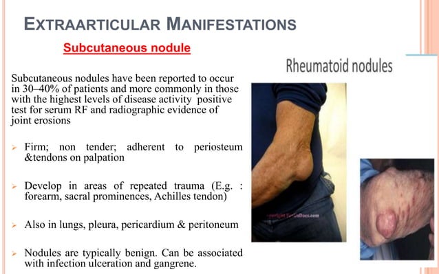 extra articular manifestation of rheumatoid arthritis.pptx | Lung and ...