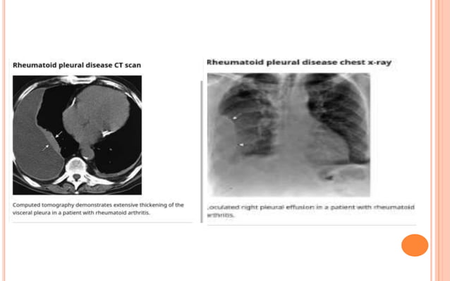 extra articular manifestation of rheumatoid arthritis.pptx | Lung and ...