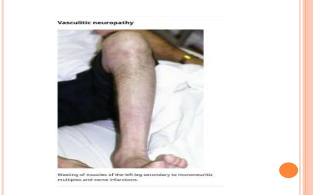 extra articular manifestation of rheumatoid arthritis.pptx | Lung and ...