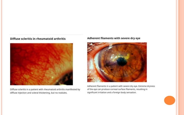 extra articular manifestation of rheumatoid arthritis.pptx | Lung and ...