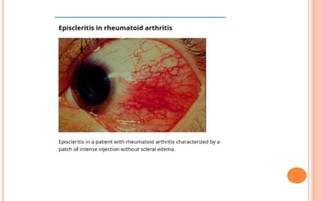 extra articular manifestation of rheumatoid arthritis.pptx | Lung and ...