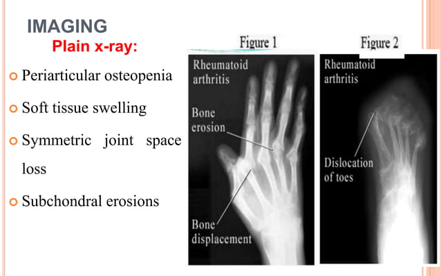 extra articular manifestation of rheumatoid arthritis.pptx | Lung and ...