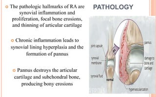 extra articular manifestation of rheumatoid arthritis.pptx