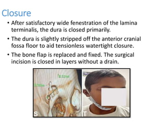 Journal Club - Extra axial Endoscopic Third Ventriculostomy.pptx