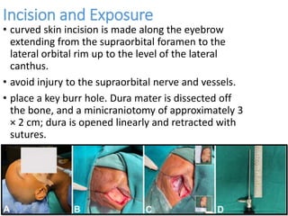Journal Club - Extra axial Endoscopic Third Ventriculostomy.pptx