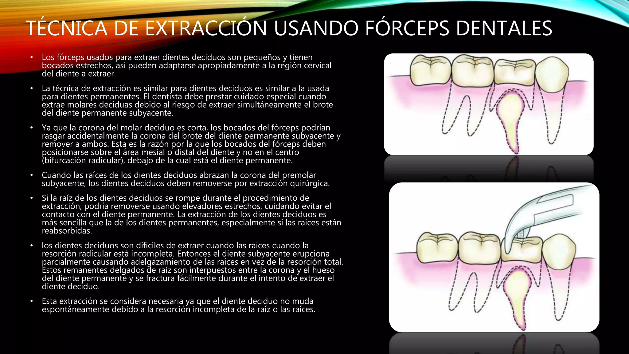 EXTRACCIÓN DENTAL SIMPLE | PPTX