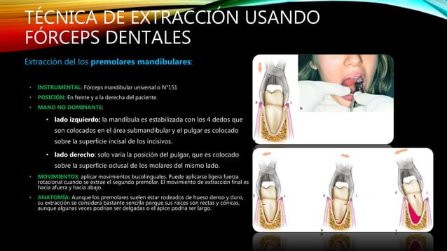 EXTRACCIÓN DENTAL SIMPLE | PPTX