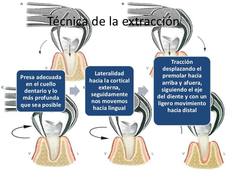 Extracción de Órganos Dentarios Mandibulares