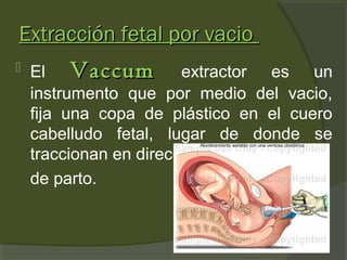 Extraccion fetal con forceps2 | PPT