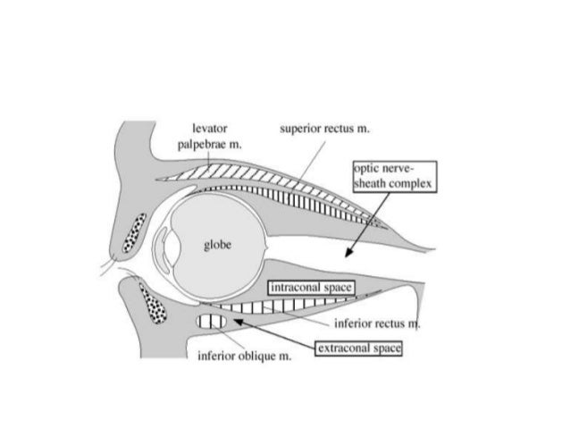 Extraconal orbital tumors