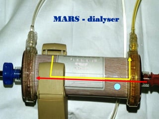 Extracorporeal liver support therapies | PDF