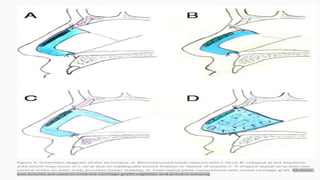 Extracorporeal Septoplasty presentation.pptx