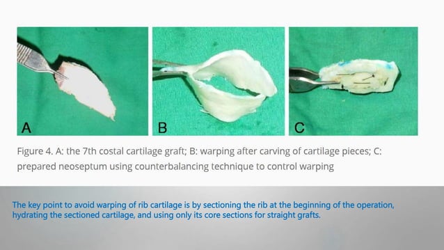 Extracorporeal Septoplasty presentation.pptx | Ear, Nose and Throat ...