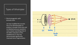 Extracorporeal shock wave lithotripsy.pptx