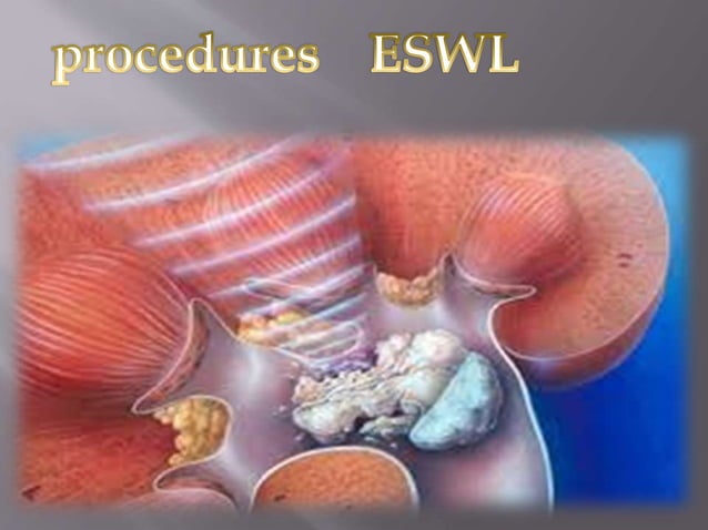 Extracorporeal shock wave lithotripsy (eswl) | PPTX