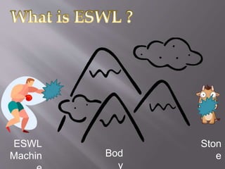 Extracorporeal shock wave lithotripsy (eswl) | PPTX