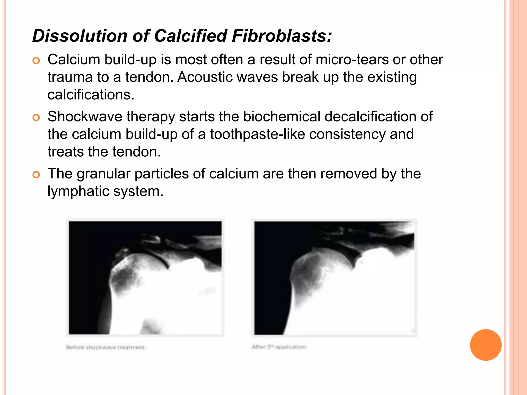 Extracorporeal shockwave therapy (eswt) | PPTX