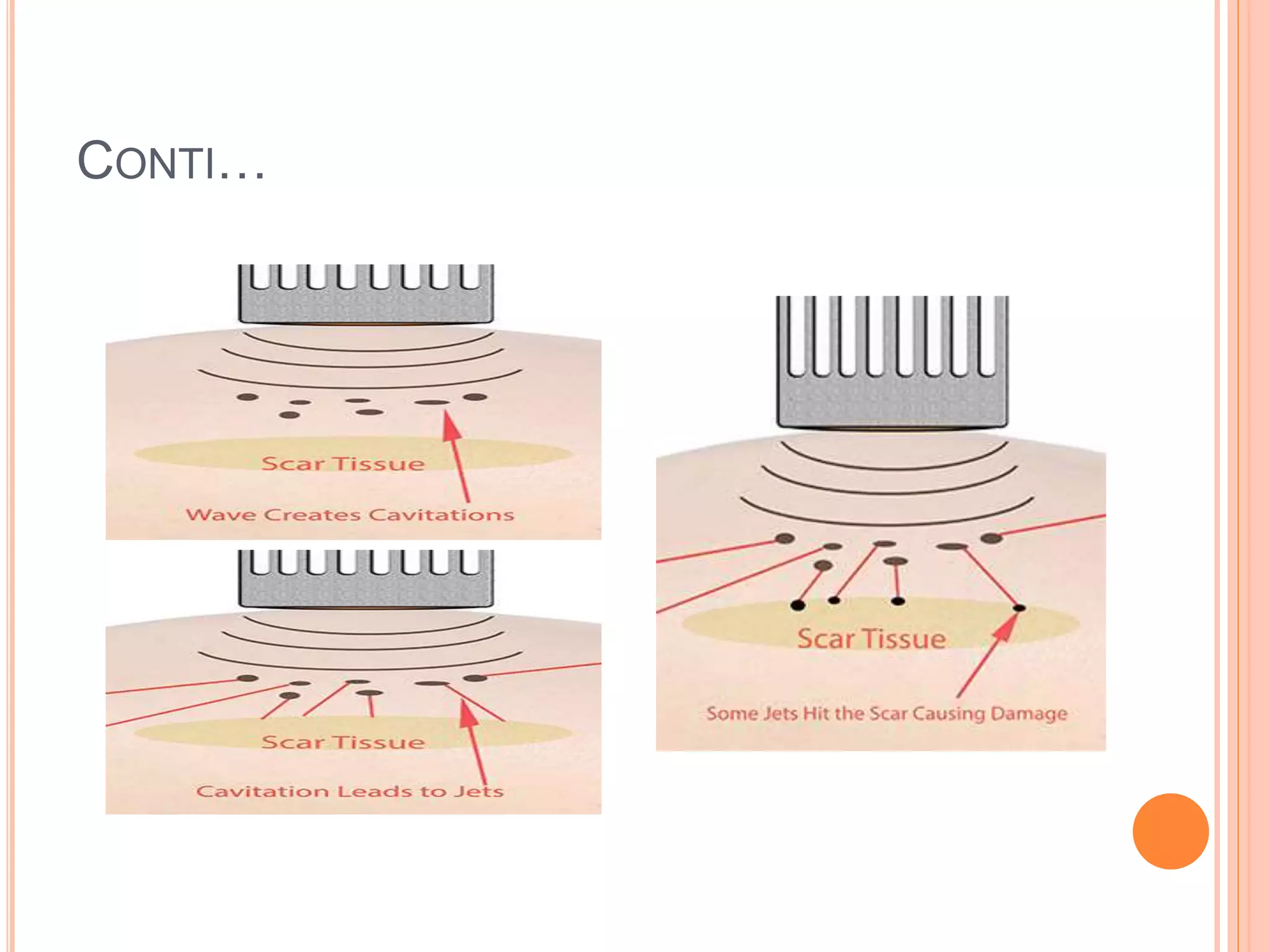 Extracorporeal shockwave therapy (eswt) | PPTX