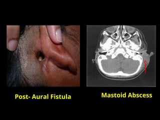 Extracranial complications of CSOM Dr. Krishna Koirala .ppt