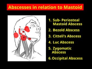 Extracranial complications of CSOM Dr. Krishna Koirala .ppt