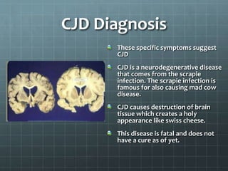 Case Study Creutzfeld-Jakob Disease | PPT