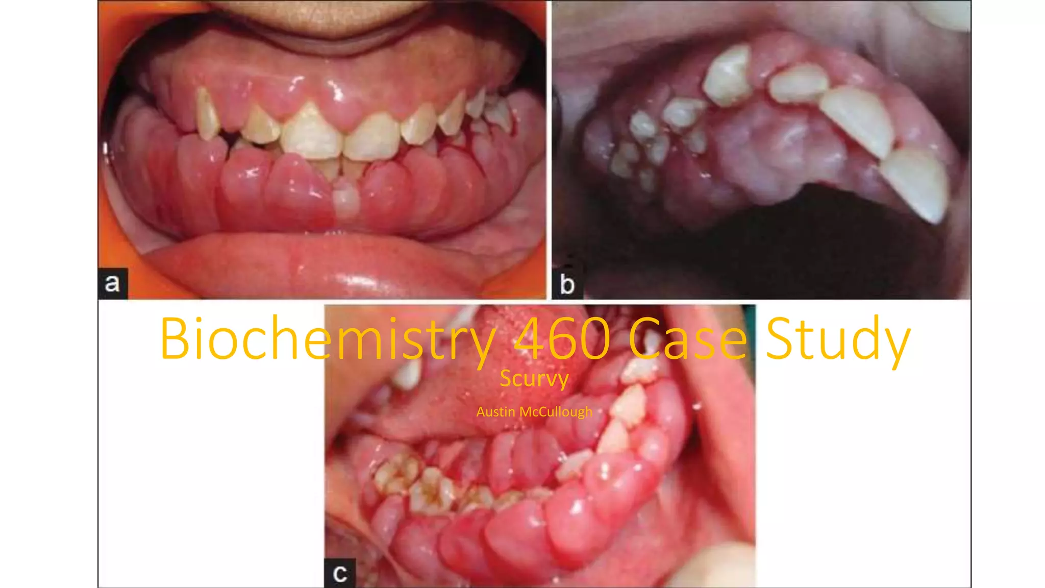 Scurvy Case Study | PPTX