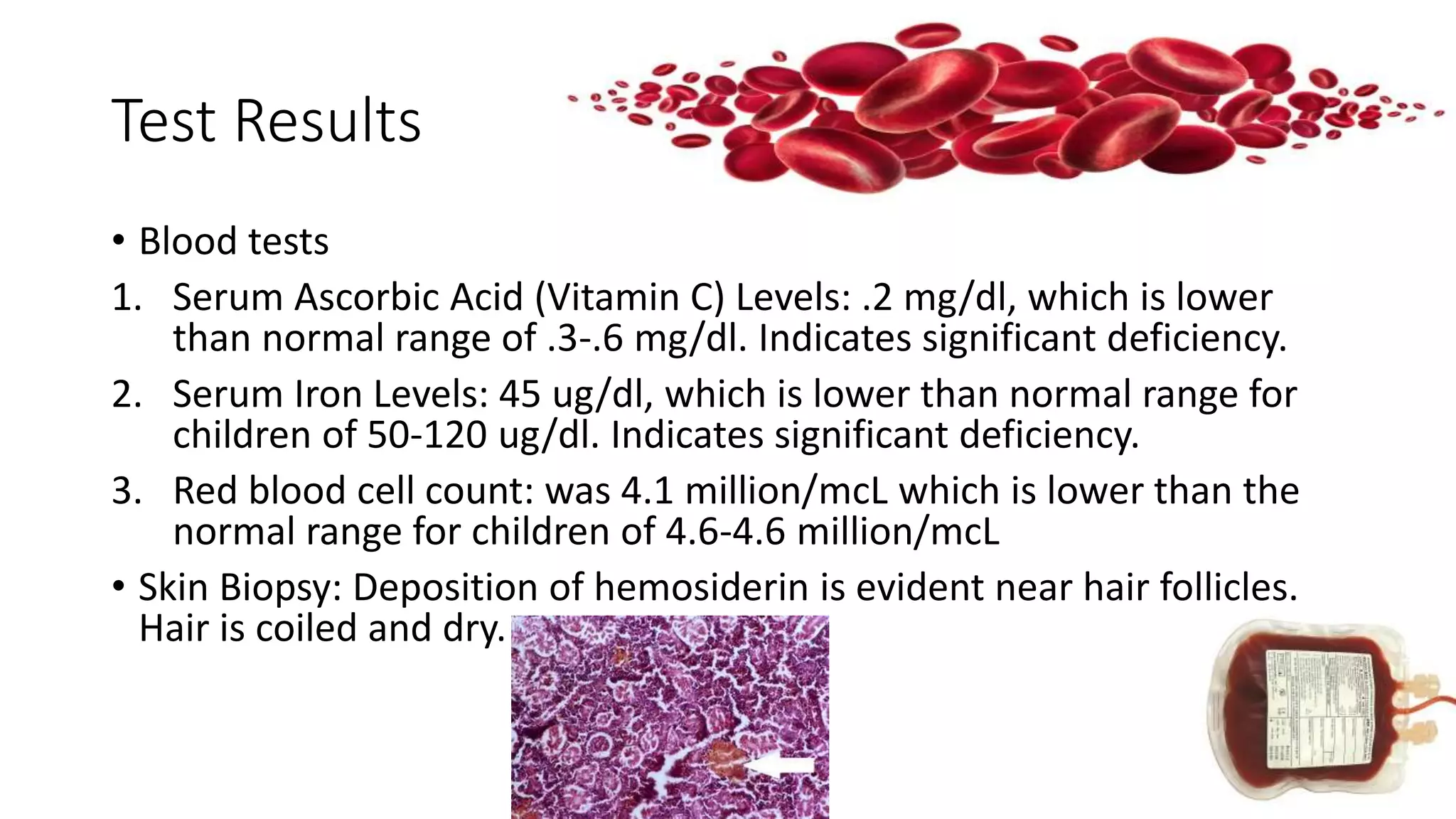 Scurvy Case Study | PPTX