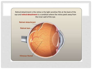 Case Study- Retina Detachment | PPTX