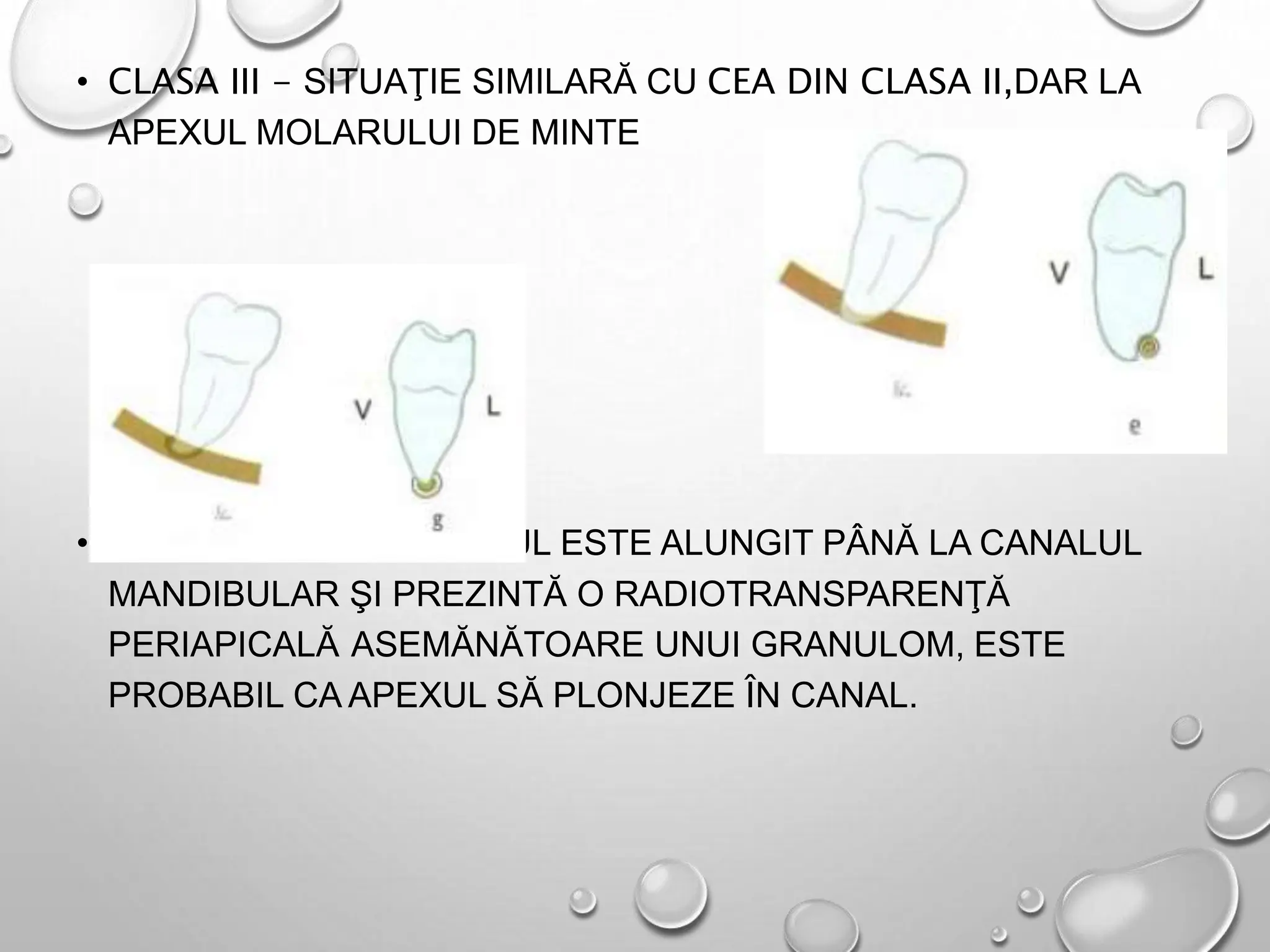 extractie-atipica....................pptx