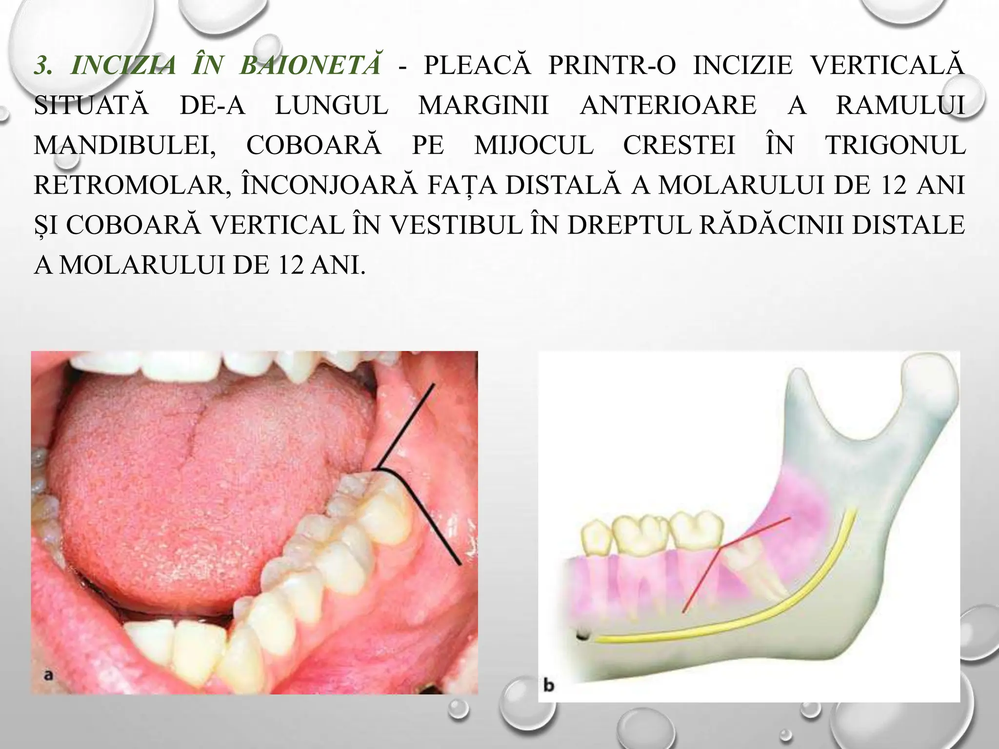 extractie-atipica....................pptx