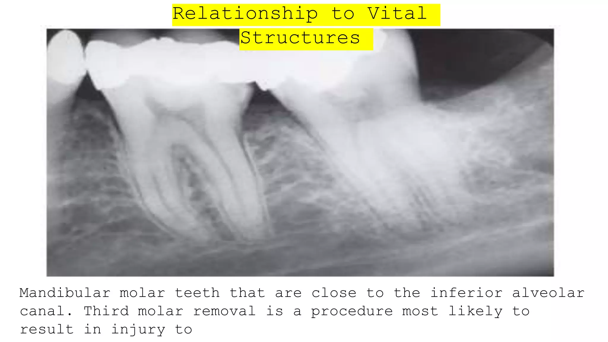 Routine Exodontia - simple extraction | PPT