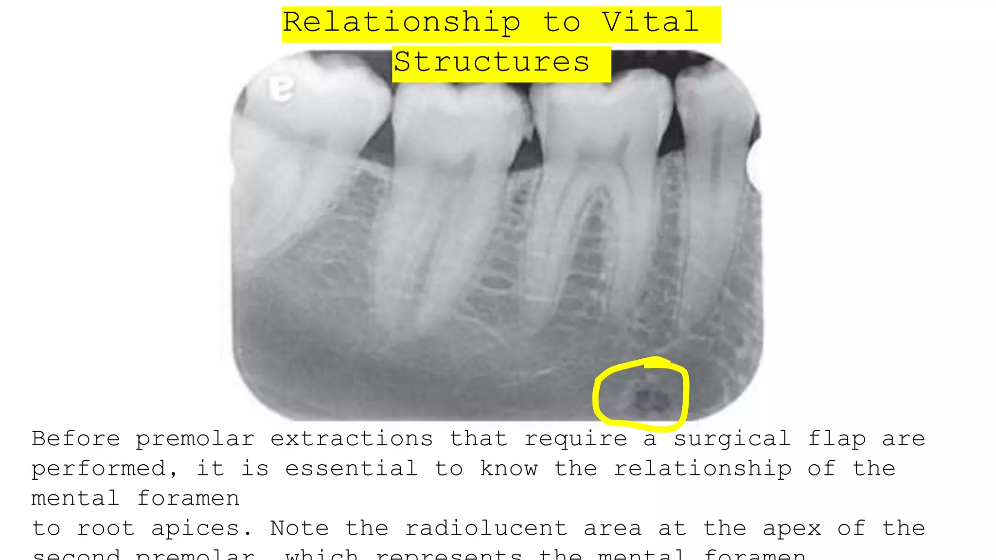 Routine Exodontia - simple extraction | PPT