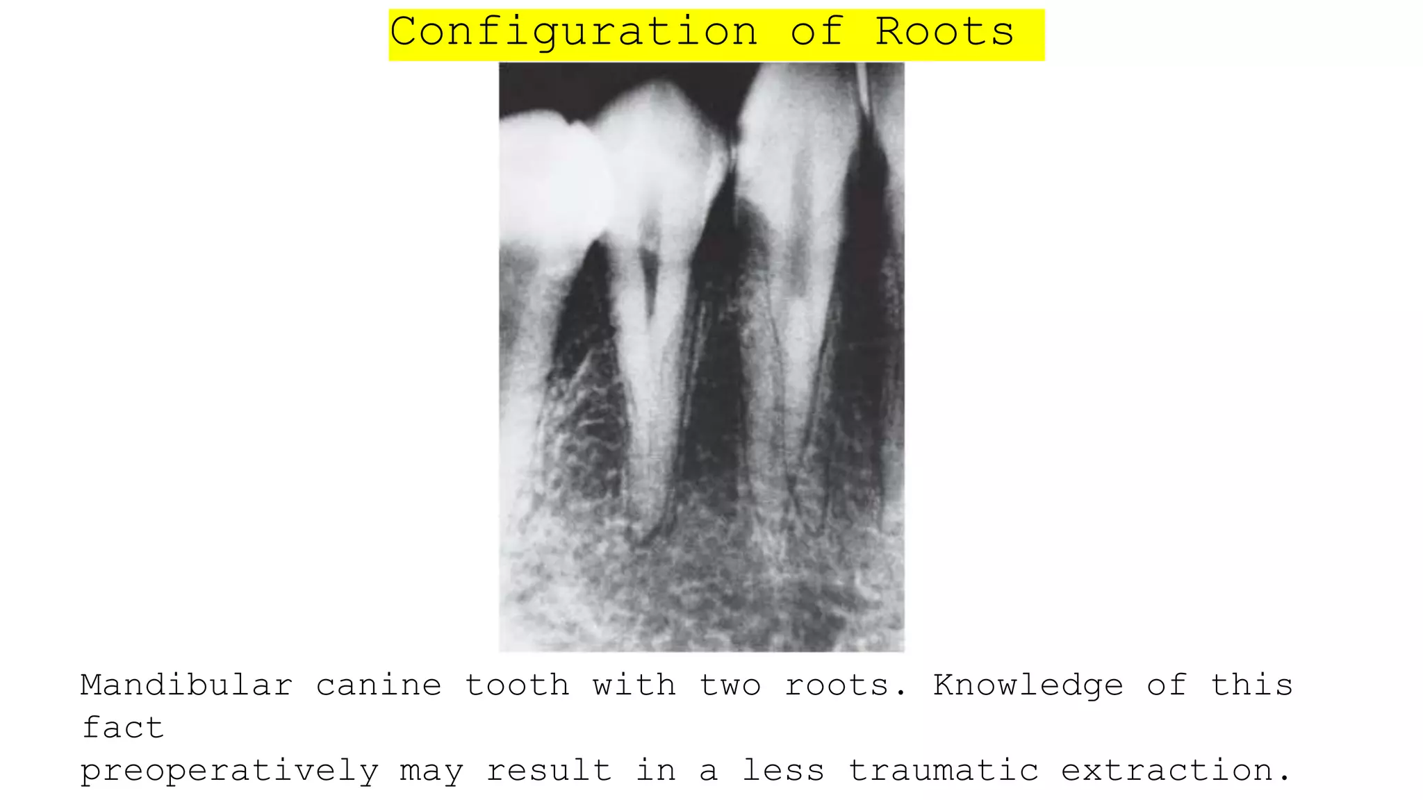 Routine Exodontia - simple extraction | PPT