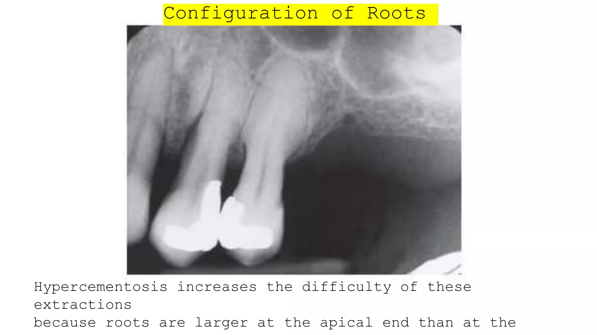 Routine Exodontia - simple extraction | PPT