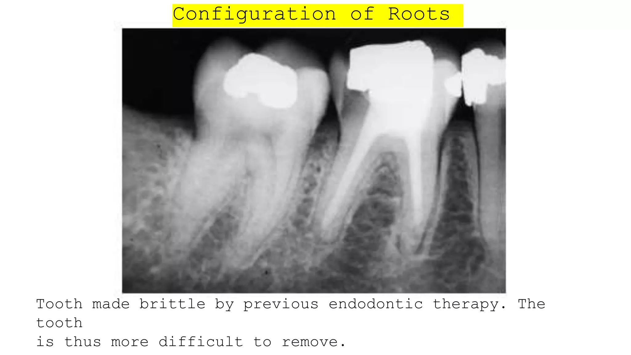 Routine Exodontia - simple extraction | PPT