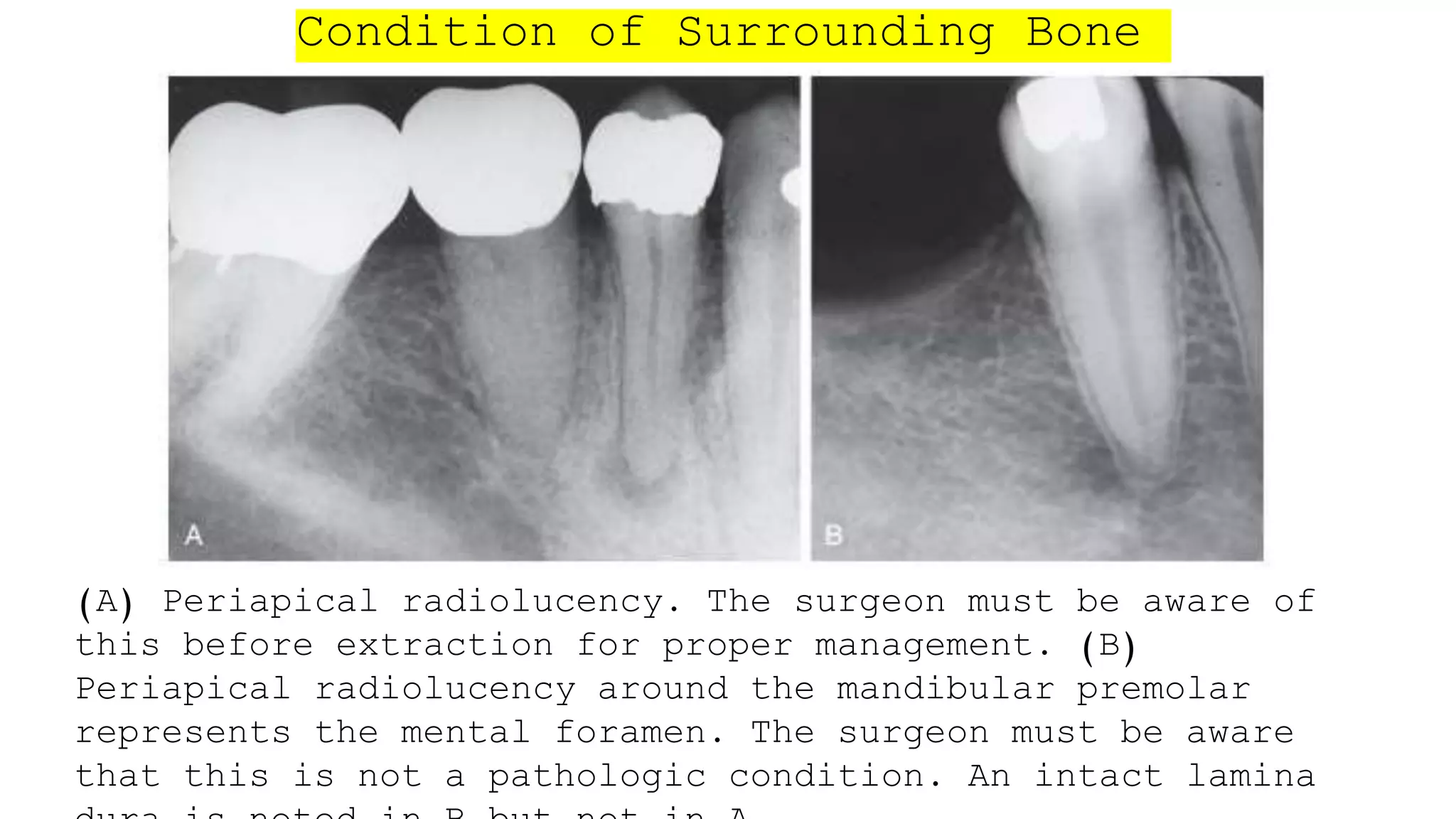 Routine Exodontia - simple extraction | PPT