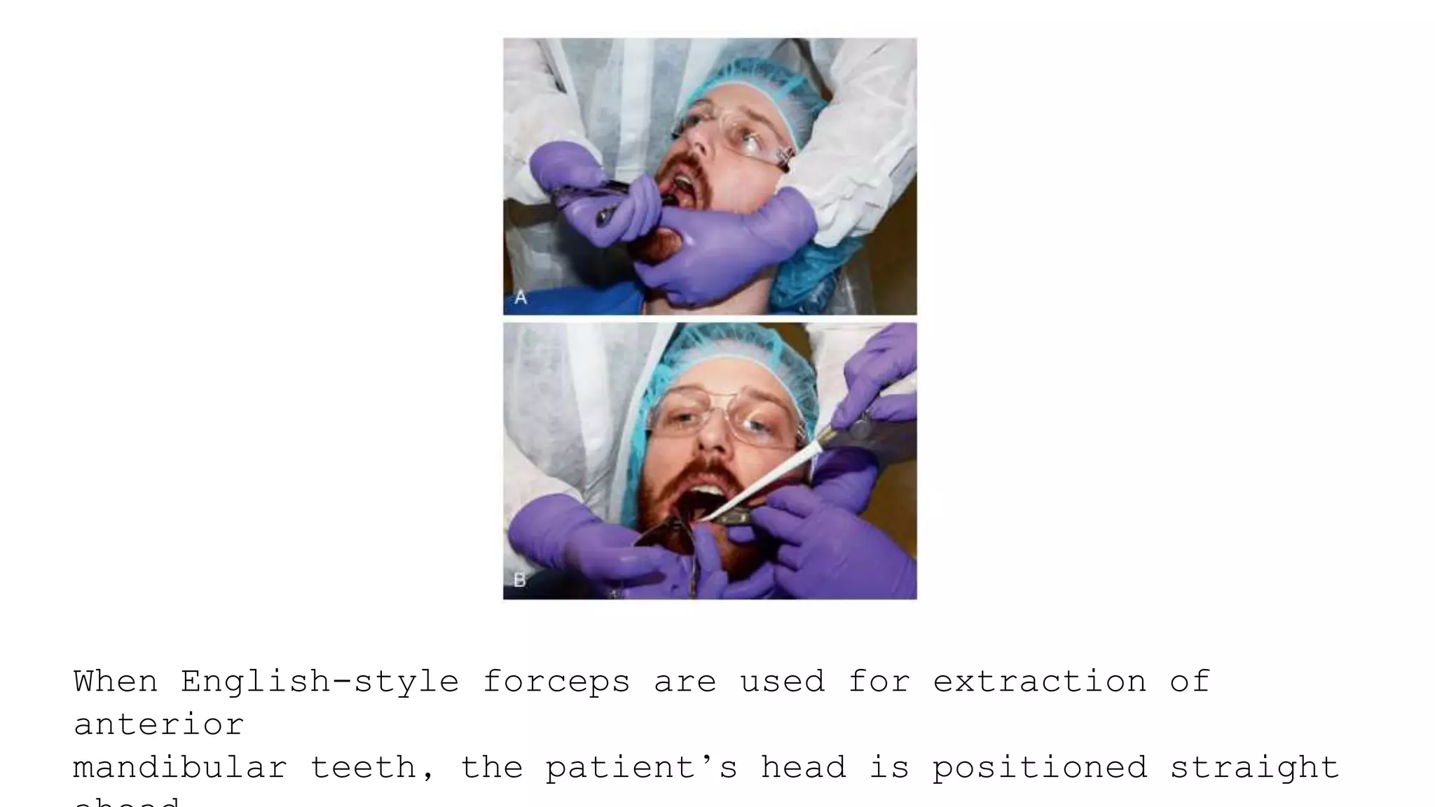 Routine Exodontia - simple extraction | PPT