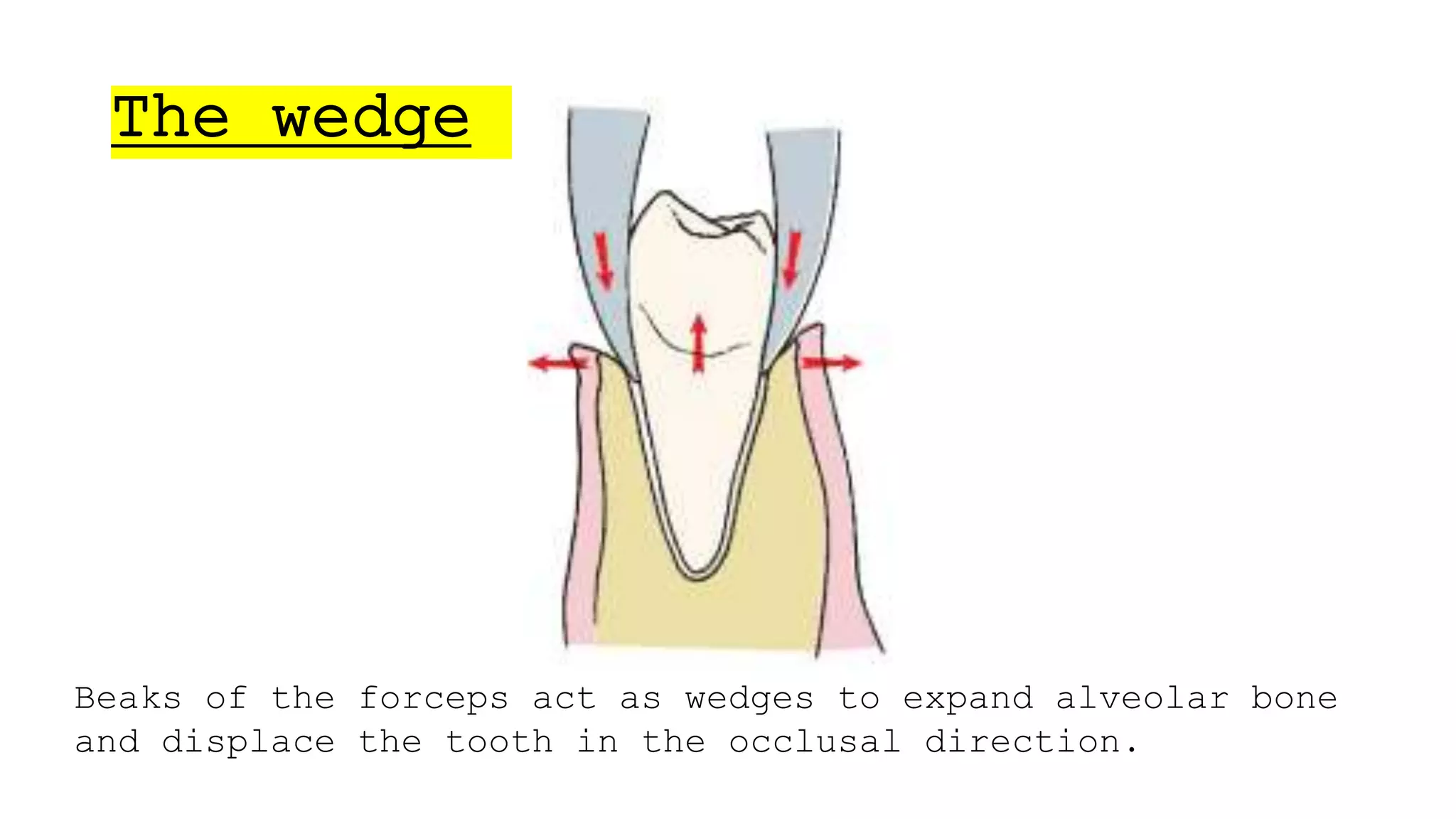 Routine Exodontia - simple extraction | PPT