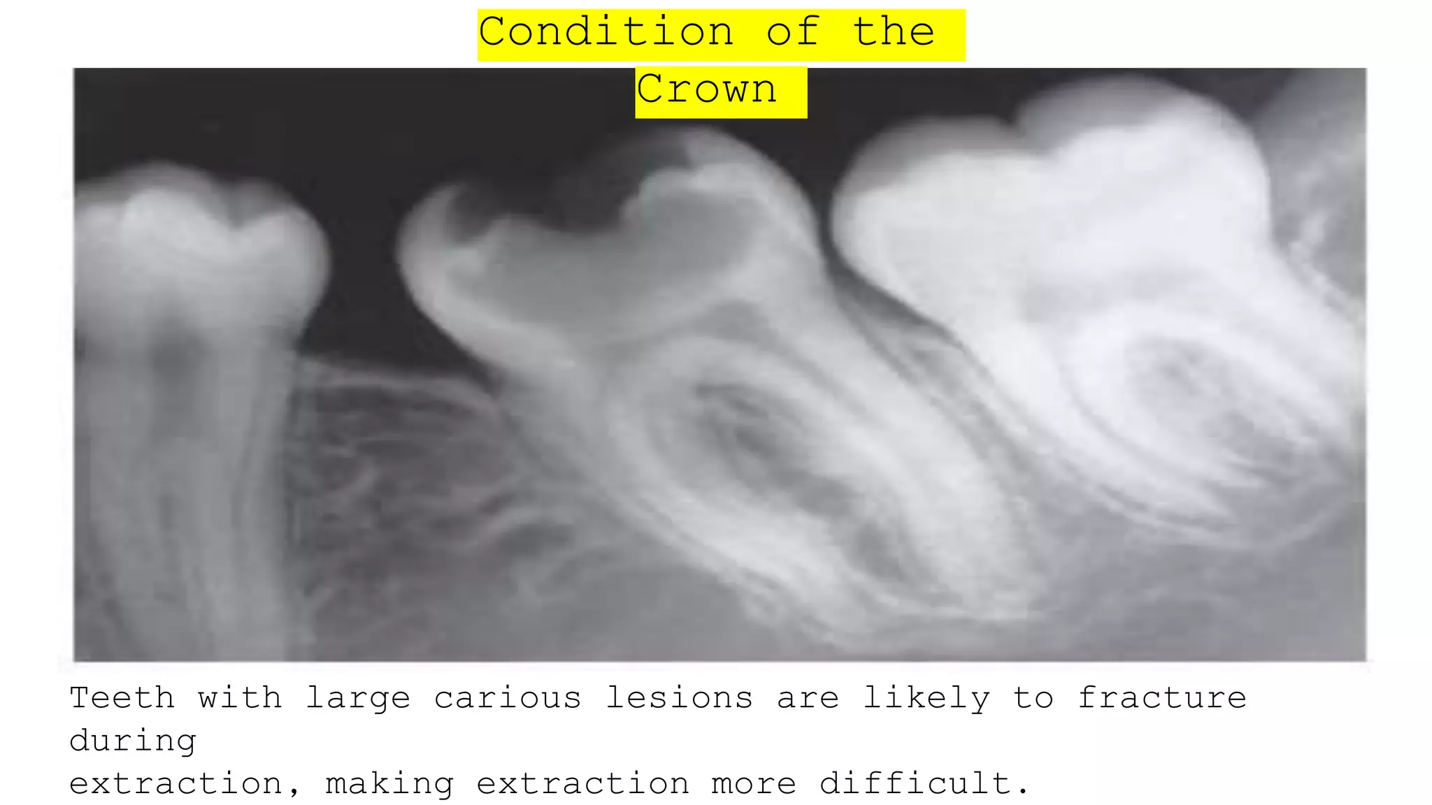 Routine Exodontia - simple extraction | PPT