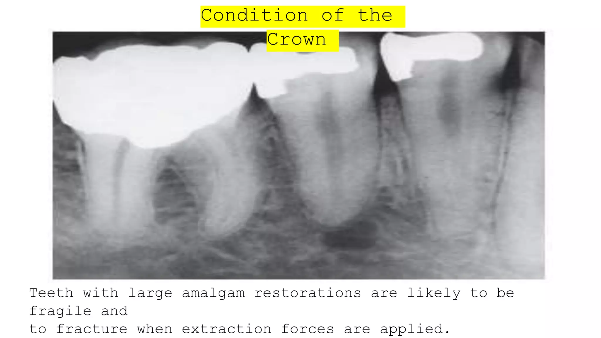 Routine Exodontia - simple extraction | PPT