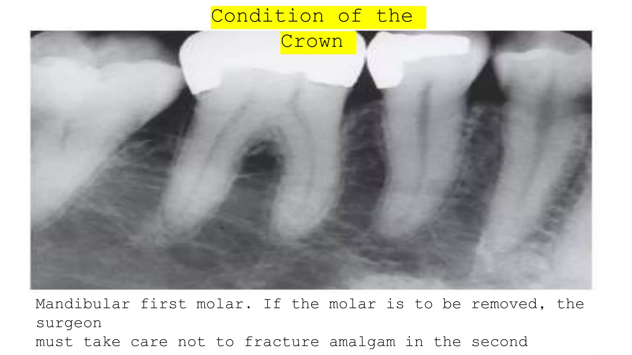 Routine Exodontia - simple extraction | PPT