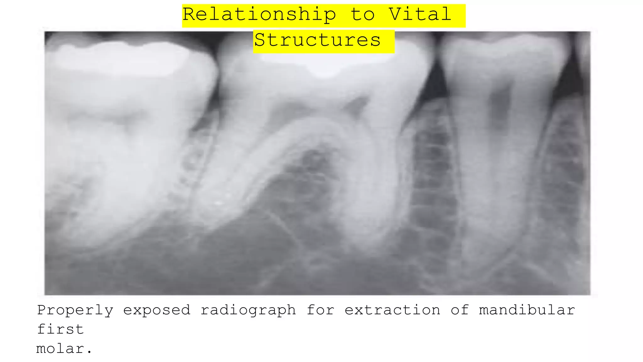 Routine Exodontia - simple extraction | PPT