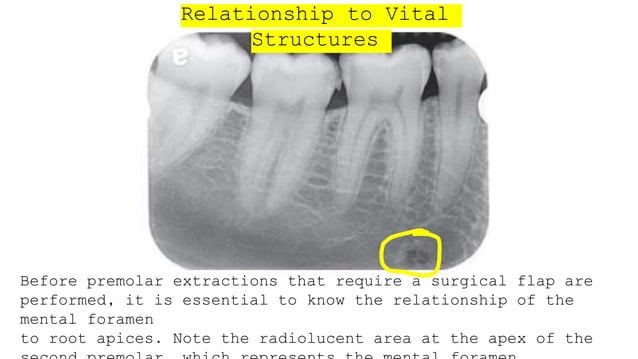 Routine Exodontia - simple extraction | PPT
