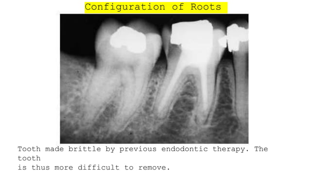 Routine Exodontia - simple extraction | PPT
