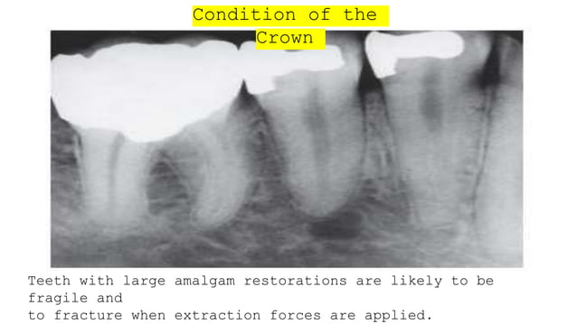 Routine Exodontia - simple extraction | PPT