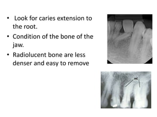 extraction teeth, Indication and contraindications 1.pdf